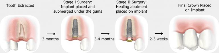 Dental Implants North Vancouver BC, Implant Placement